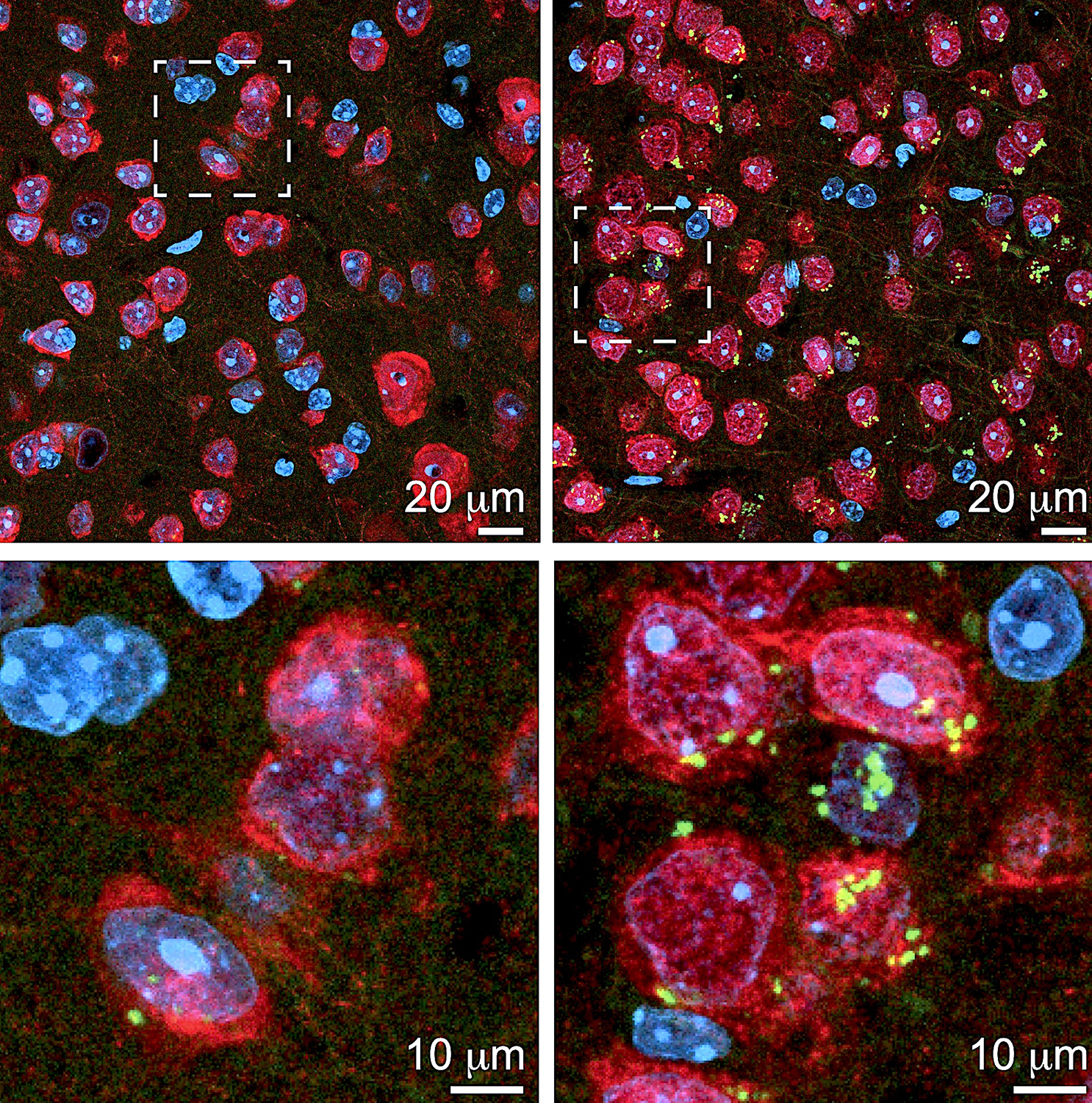 Aging slows breakdown of synaptic proteins, raising disease risk ...