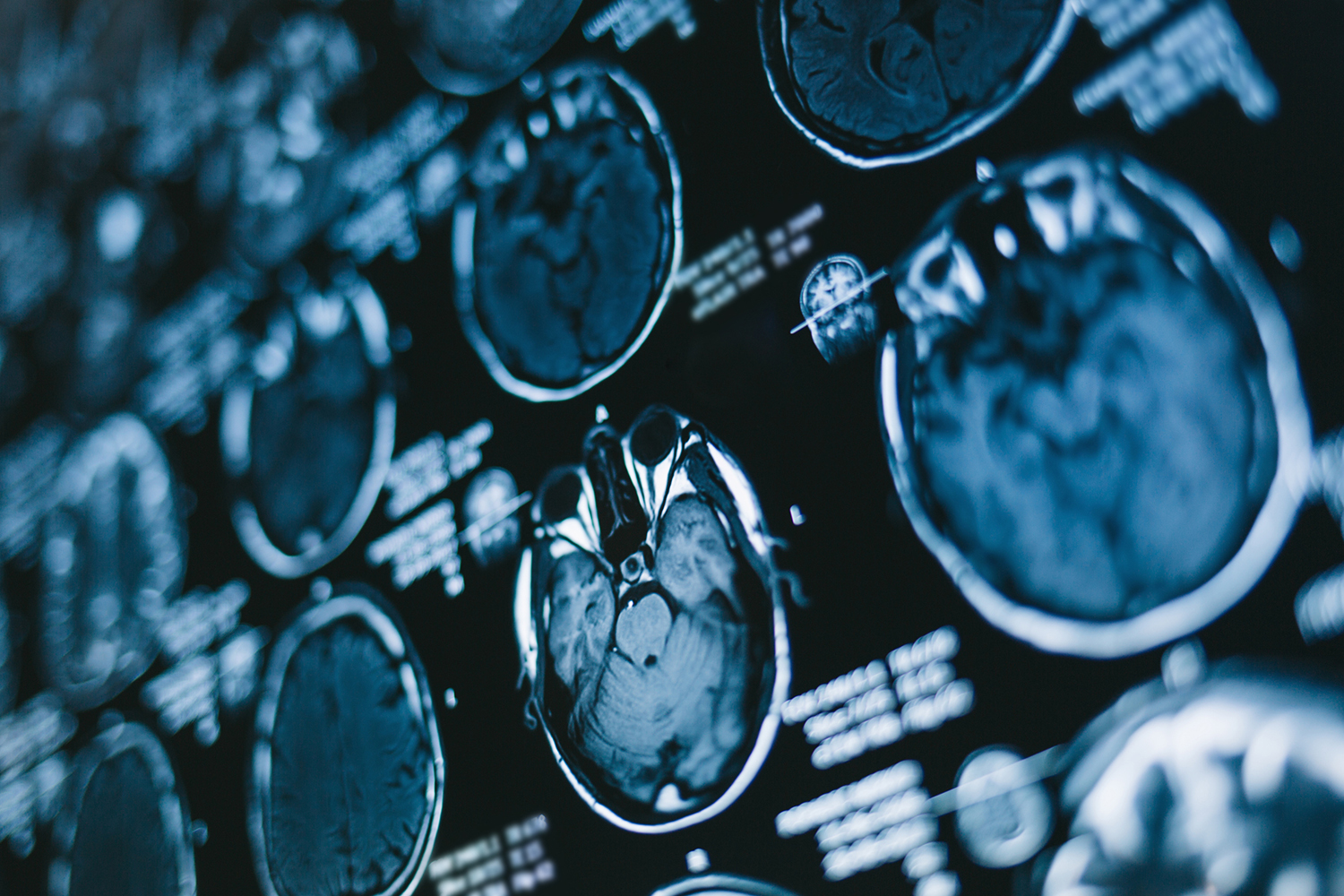 Rethinking Alzheimer’s: Untangling the sticky truth about tau ...